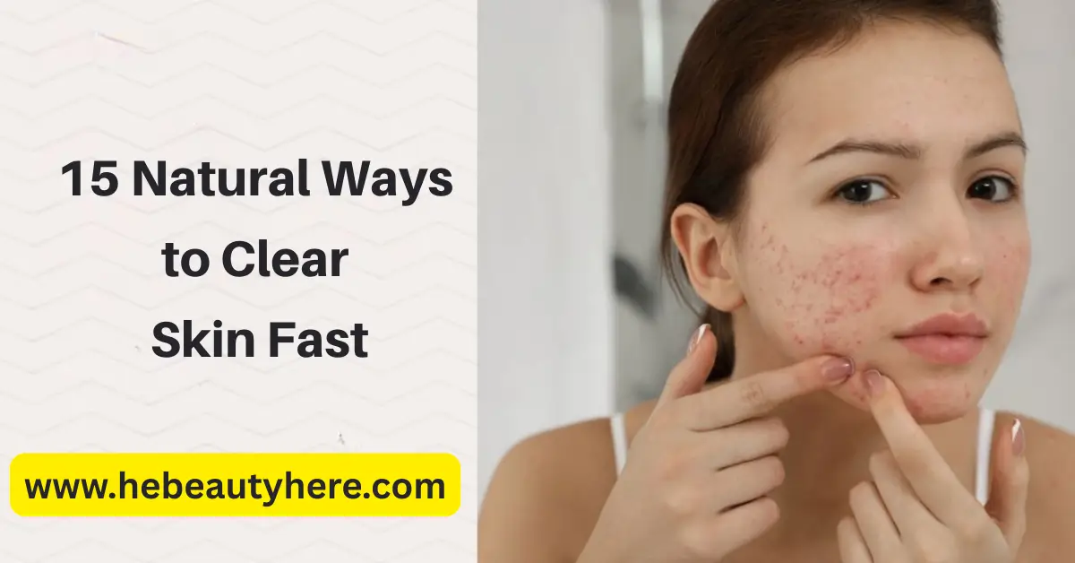 Pimple Remedies: 15 Natural Ways to Clear Skin Fast