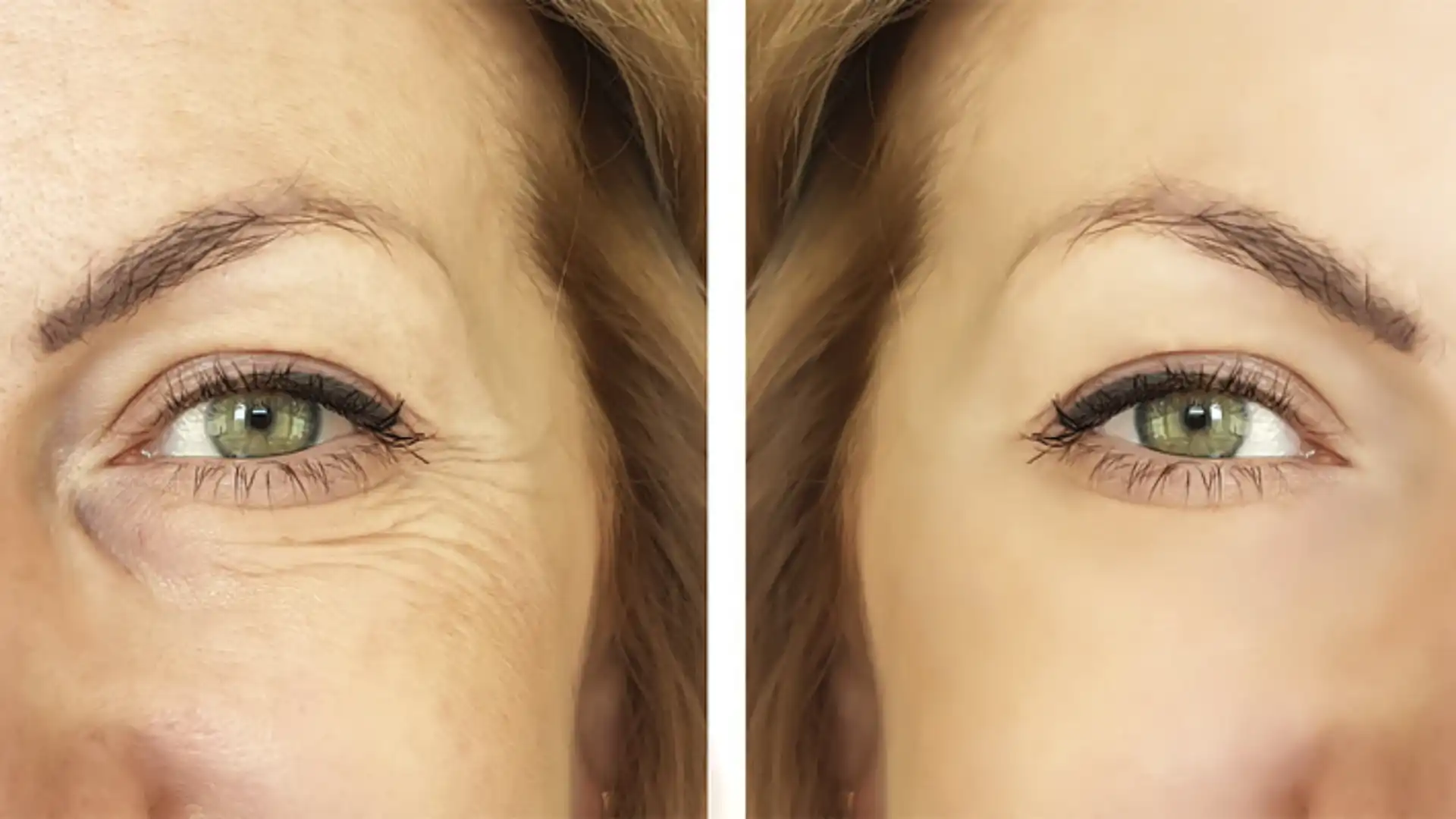 Fine Lines vs Wrinkles: Discover the Secrets to Ageless Skin