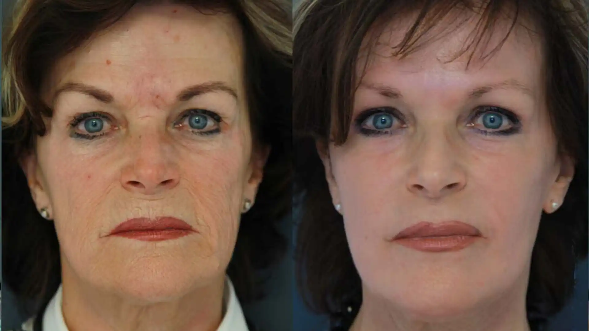 Phenol Peel : Understanding the Controversial Skin Treatment